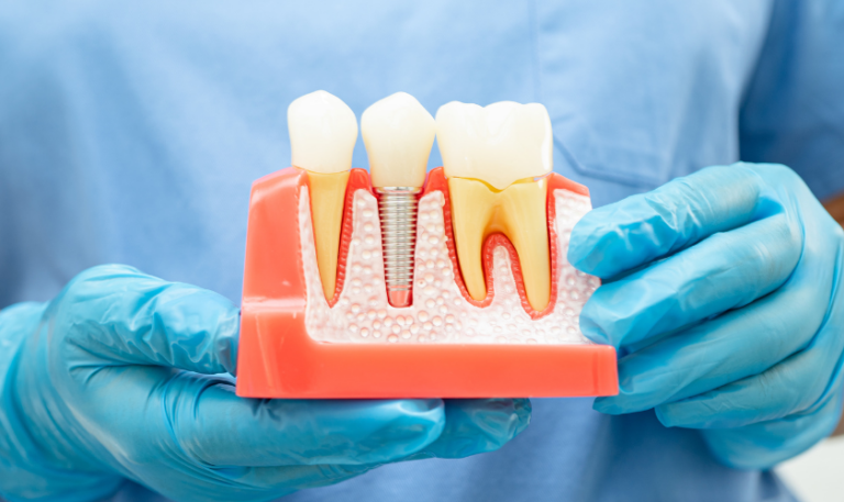 Know How Long You Can Wait Before Getting a Root Canal
