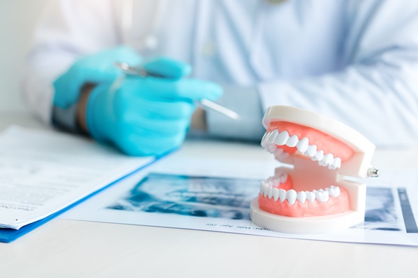 Everything You Need to Know About Dental Veneers